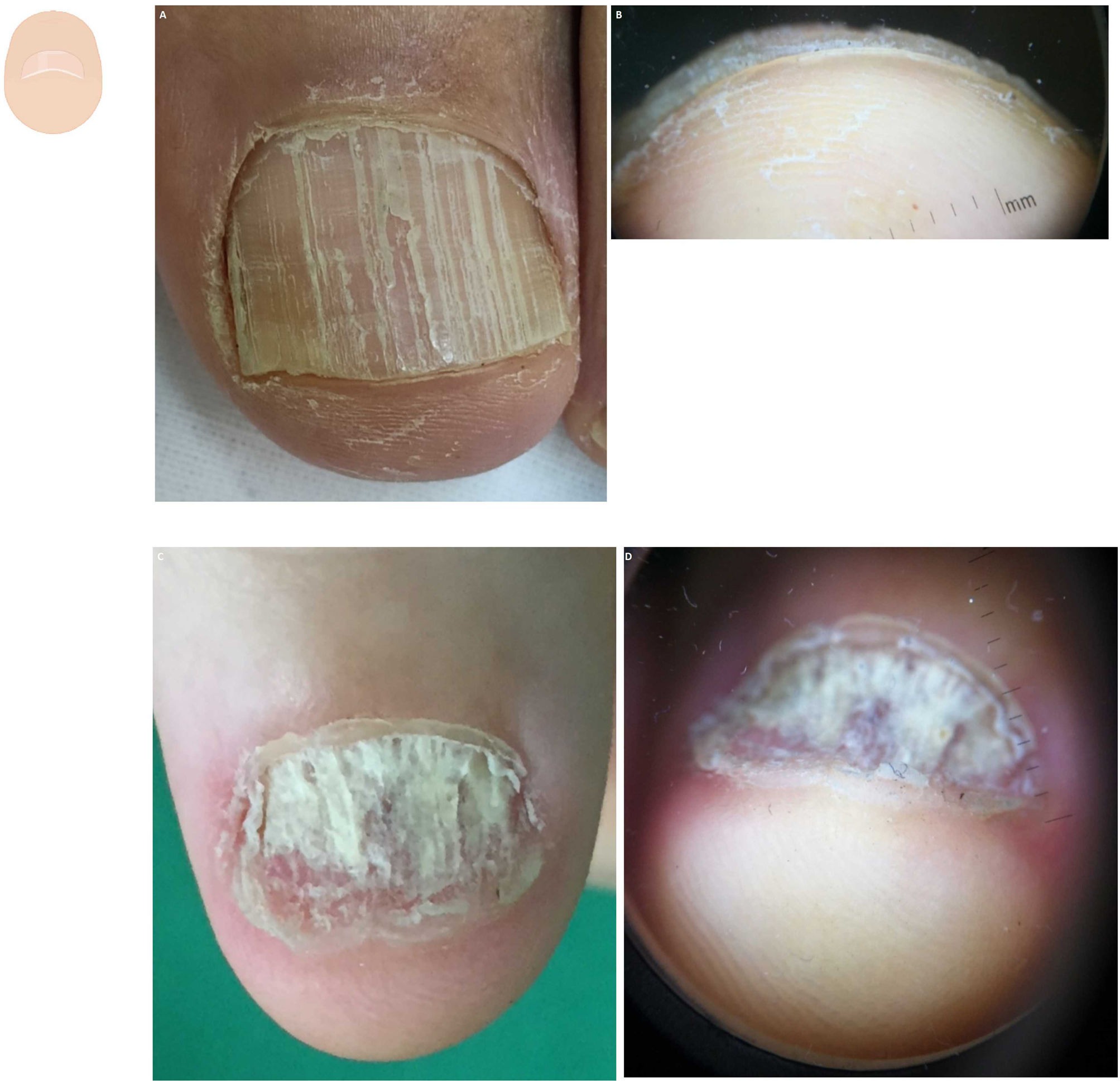 [Translated article] Frontal Examination of the Distal Nail Unit ...