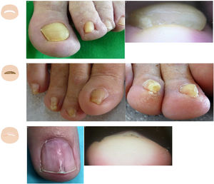 [Translated article] Frontal Examination of the Distal Nail Unit | Actas Dermo-Sifiliográficas