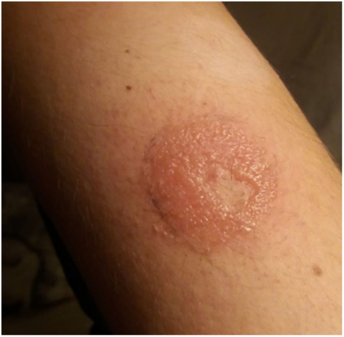 diabetic dermatitis