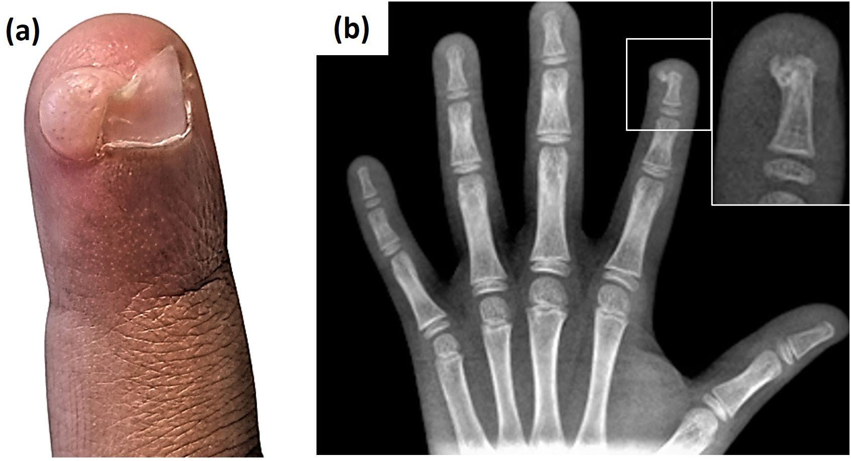 Subungual Exostosis of the Second Finger | Actas Dermo-Sifiliográficas