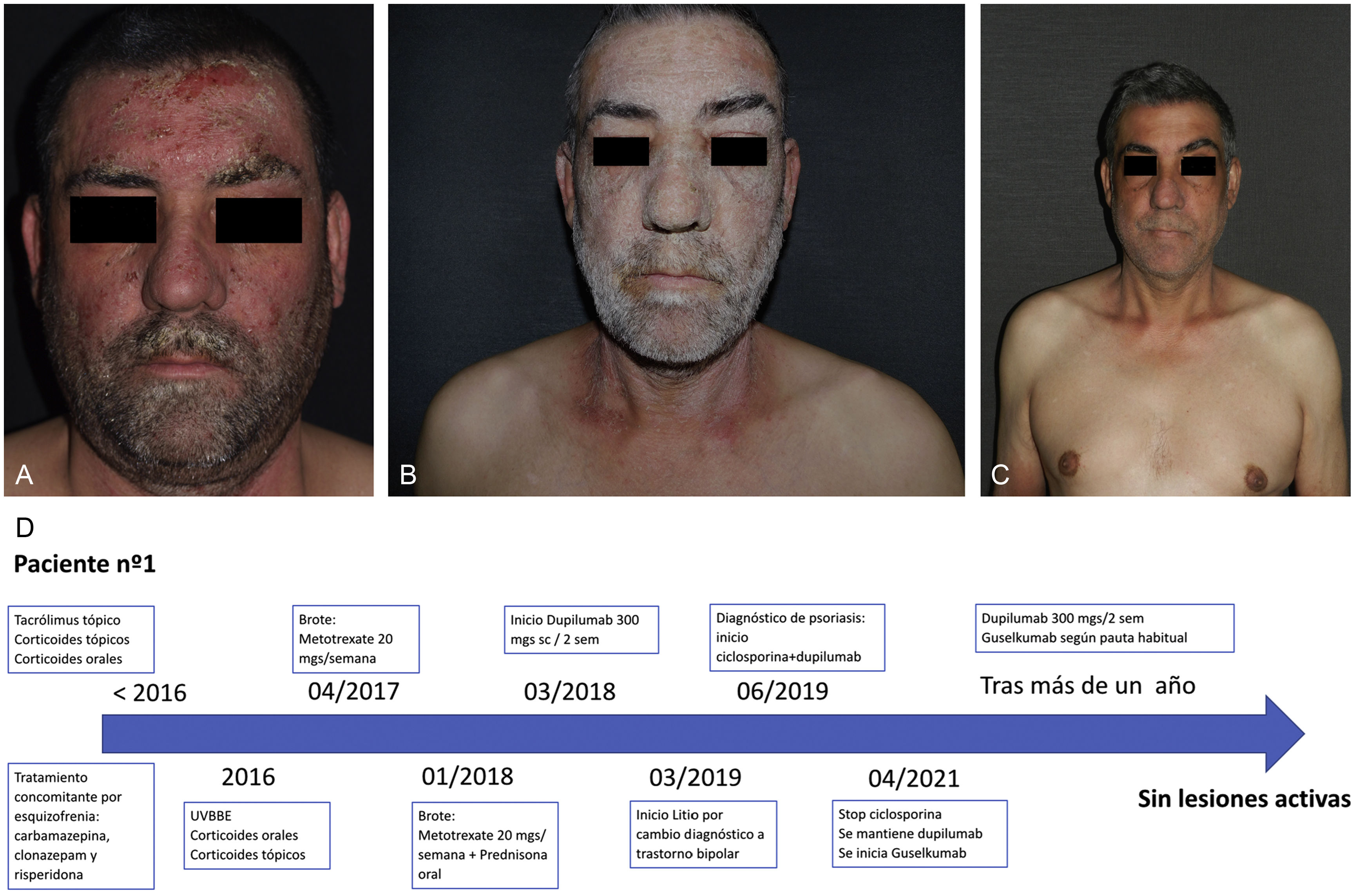 Tratamiento Biol gico Combinado En 2 Pacientes Con Psoriasis Y Tratamiento Biol gico Combinado En 2 Pacientes Con Psoriasis Y