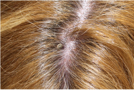 tick bite on human head