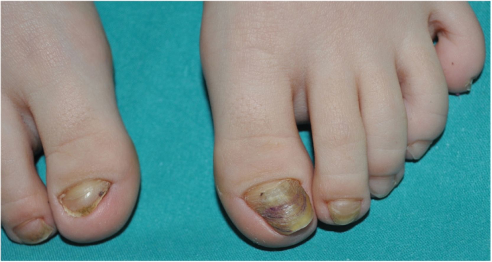 [Translated article] Congenital and Hereditary Nail Disease | Actas ...
