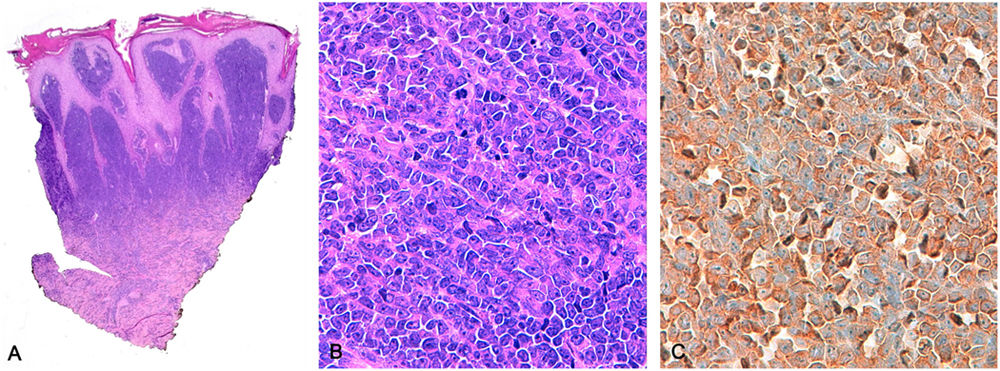 Sarcoma Mieloide Tras Remisi n completa De Leucemia Mieloide Aguda Sarcoma Mieloide Tras Remisi n completa De Leucemia Mieloide Aguda