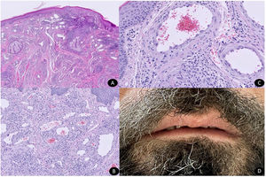 Nódulo eritematoso en labio superior | Actas Dermo-Sifiliográficas