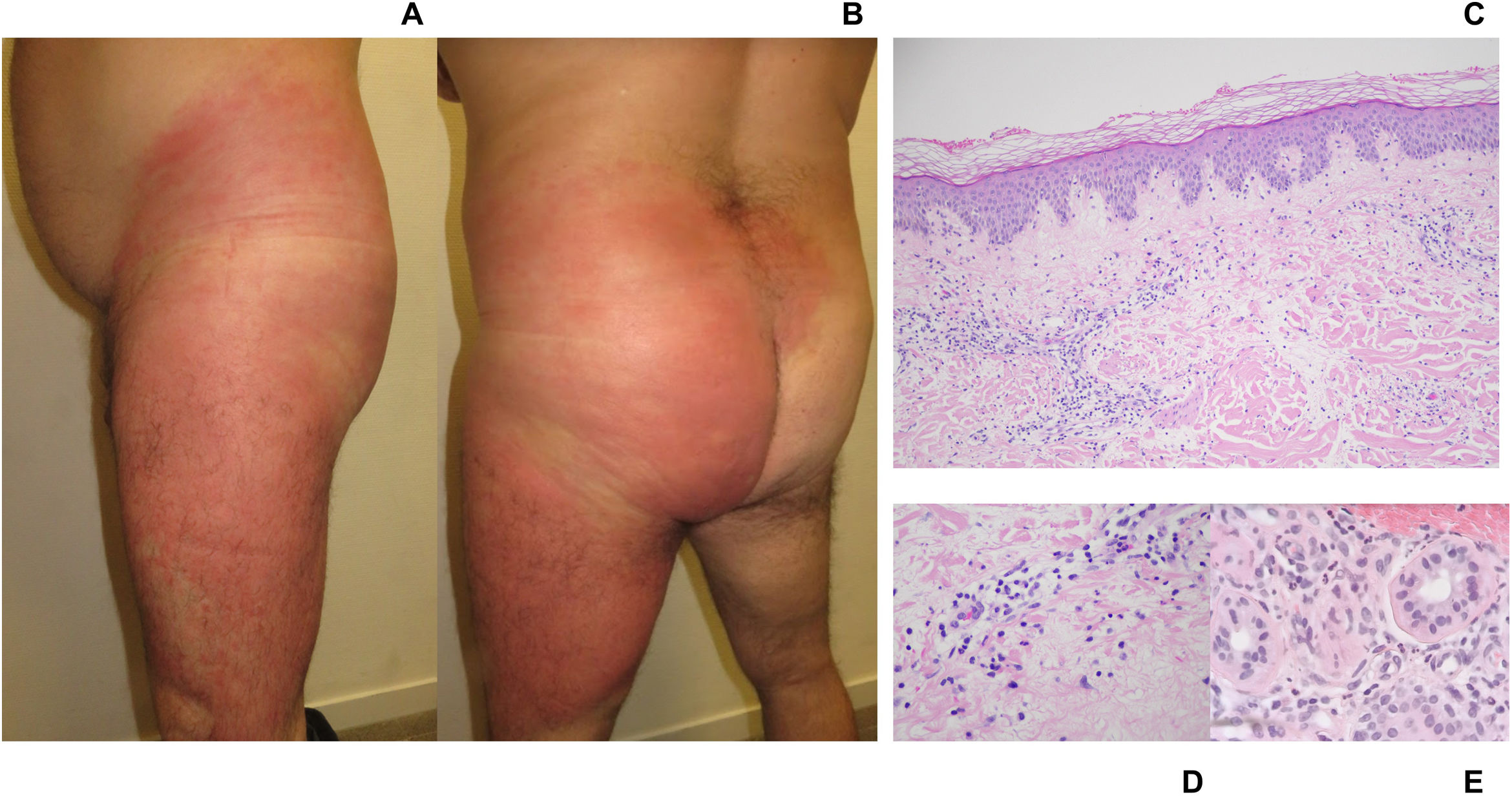 cellulitis on upper thigh