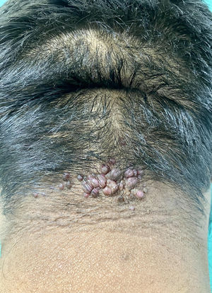 Acné queloideo de la nuca, un reto terapéutico para los dermatólogos ...