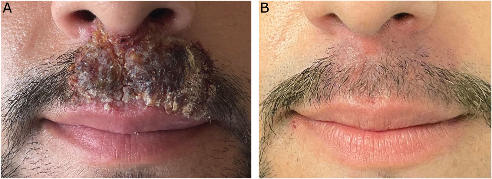 tinea barbae under microscope