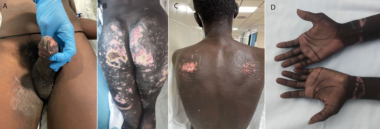 The Reality of Migration by Patera Boats: Morbidity and Dermatological ...