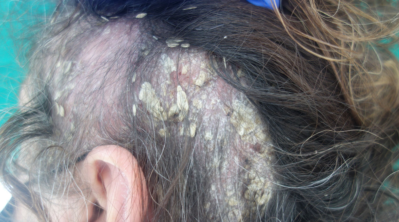 Management of Immune-Mediated Alopecia With Tumor Necrosis Factor Alpha ...