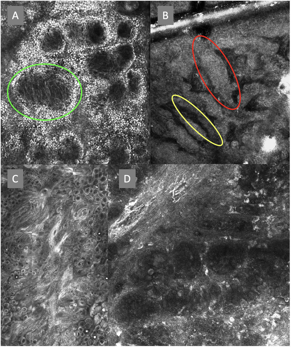 Consenso de terminología en microscopia confocal de reflectancia en ...