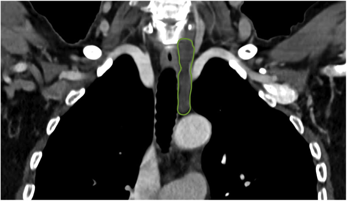 Spontaneous Cervical Mass | Actas Dermo-Sifiliográficas