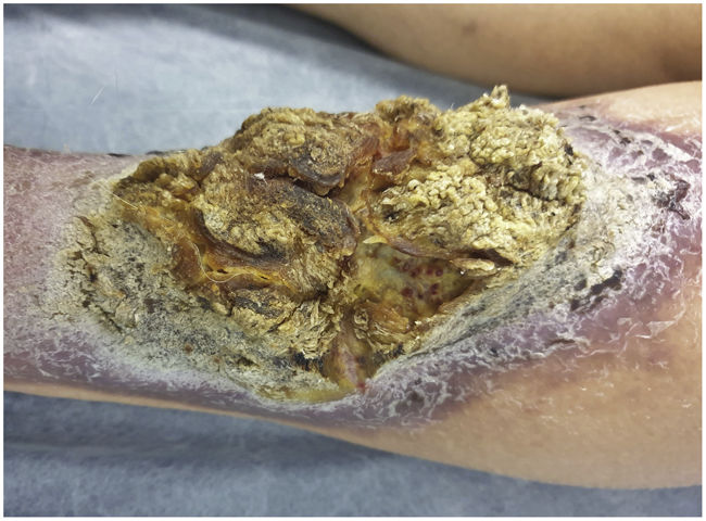 Sarcoma mieloide tras remisión «completa» de leucemia mieloide aguda ...