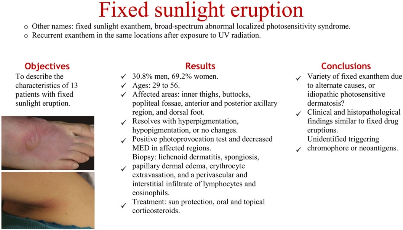 [Translated article] Fixed Sunlight Eruption: A Series of 13 Cases in ...