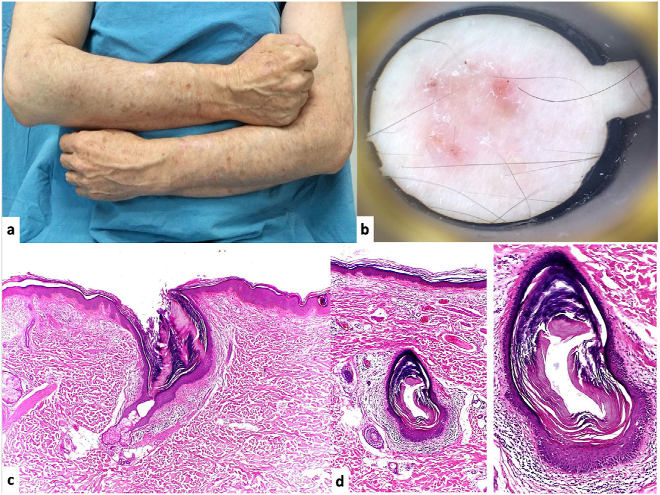 [Translated article] Is Follicular Porokeratosis a Distinct Clinical ...