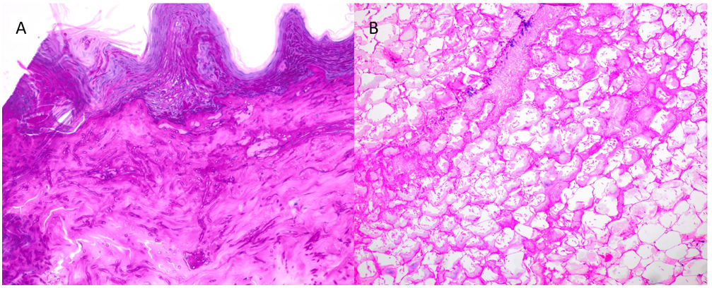 Erythematous Papules, Plaques, and Nodules in a Patient With Acute ...