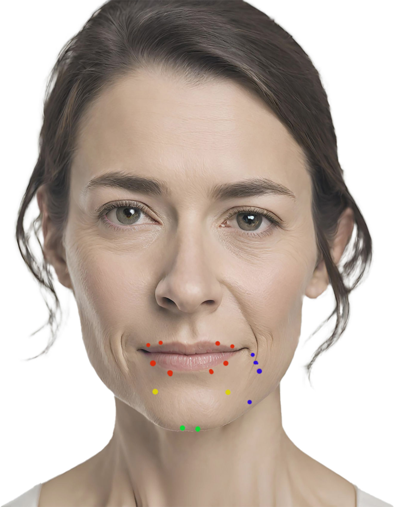 Botulinum Toxin for Esthetic Use in Facial and Cervical Regions: A ...