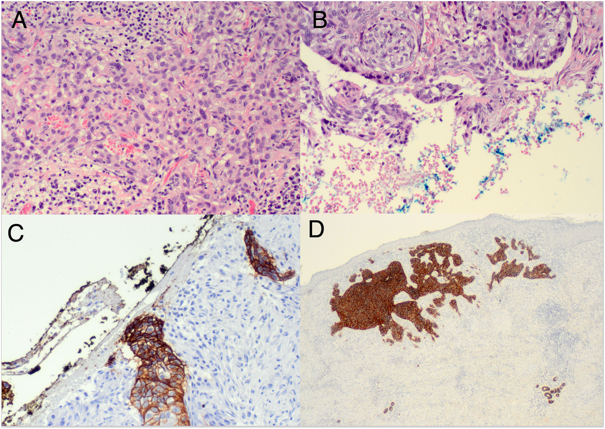 Treatment of Basosquamous Carcinoma With Sonidegib in a Patient with ...