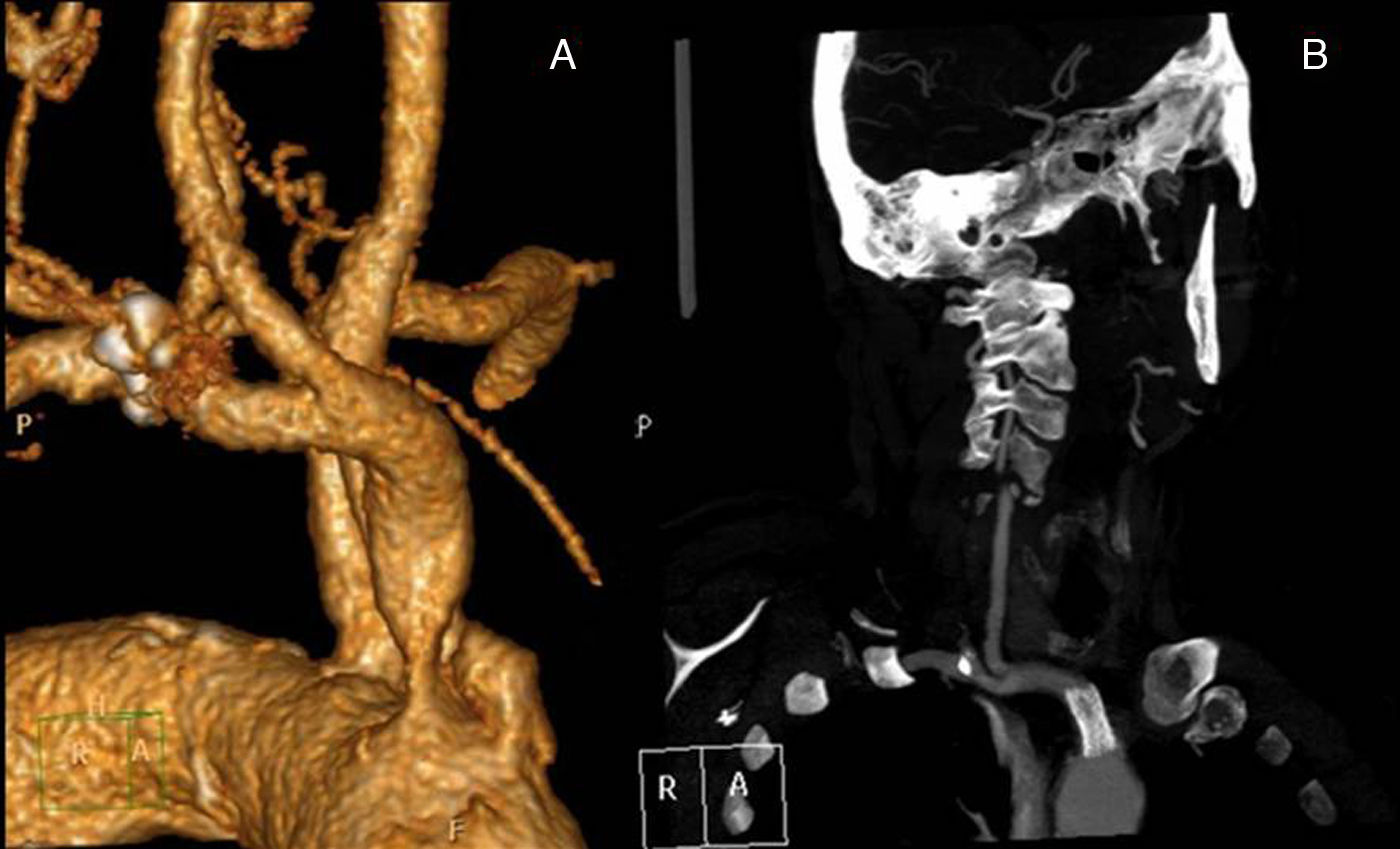 Tratamiento endovascular de estenosis sintomática de tronco ...