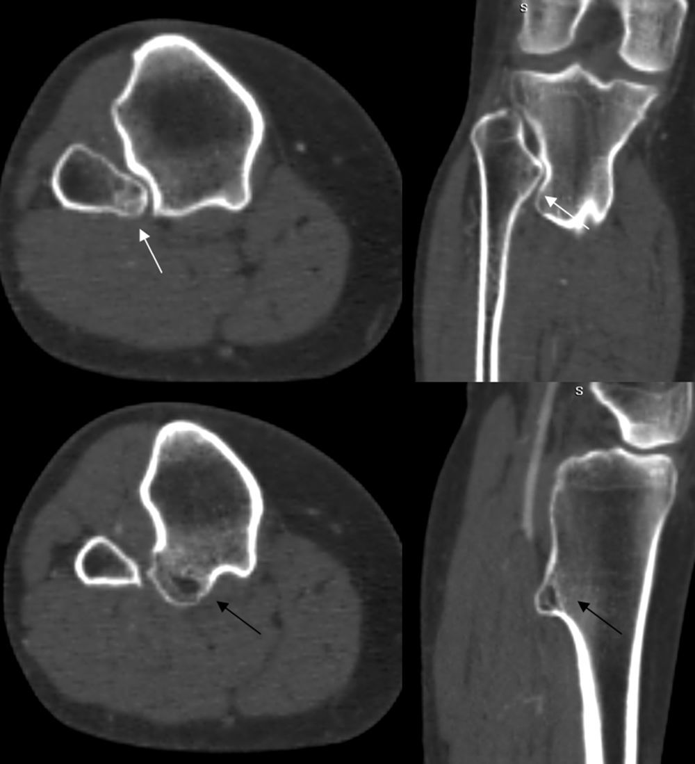Trombosis arterial secundaria a exostosis de tibia y peroné | Angiología