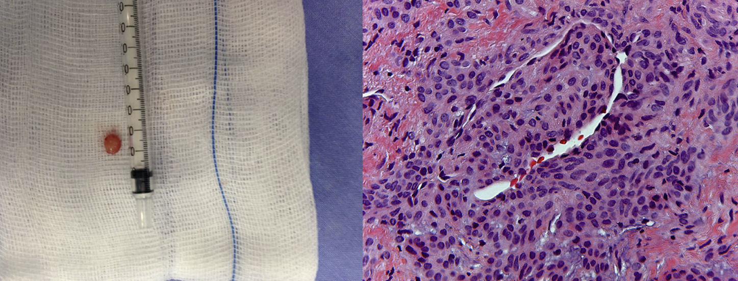 Dolor incapacitante por tumor glómico en pulpejo de dedo | Angiología