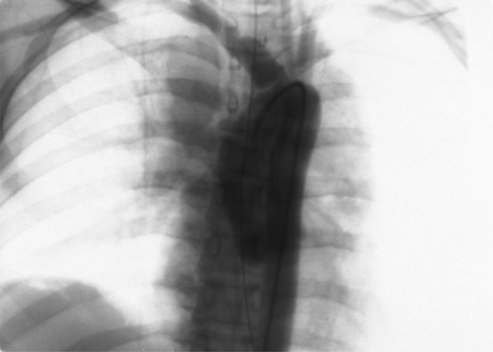 Avulsión del tronco arterial innominado por aplastamiento torácico ...