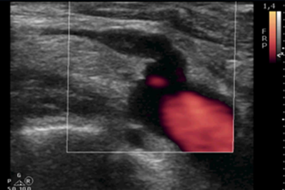 Edema laterocervical izquierdo recurrente en paciente joven | Angiología