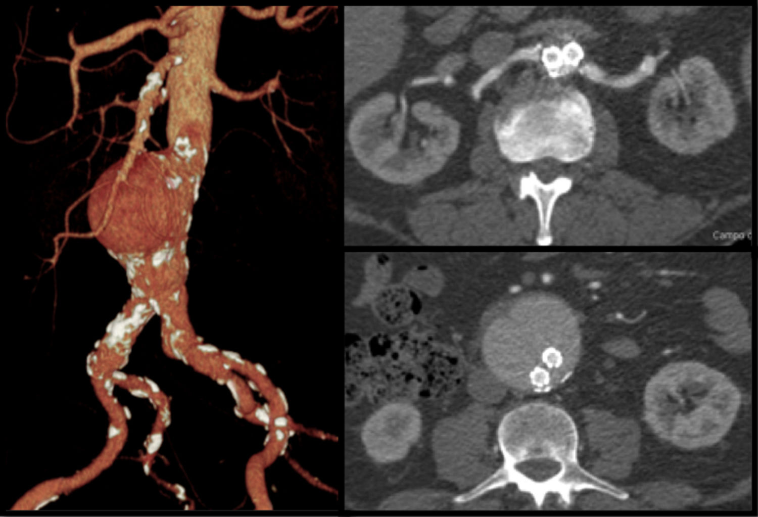 Experiencia en nuestro centro con Nellix: EndoVascular Aneurysm Sealing ...