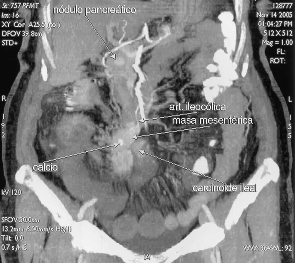 Isquemia intestinal secundaria a tumor carcinoide ileal | Cirugía Española