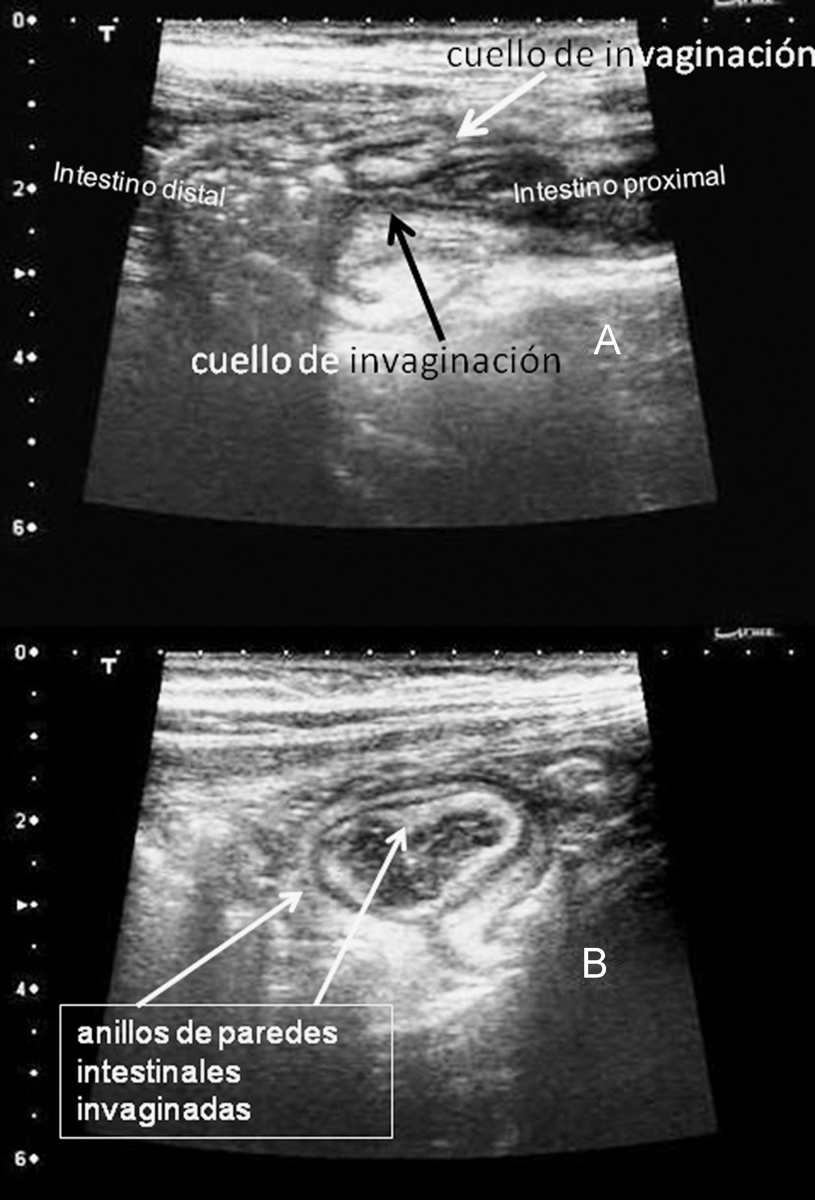 Invaginación intestinal en el adulto: presentación de un caso y ...