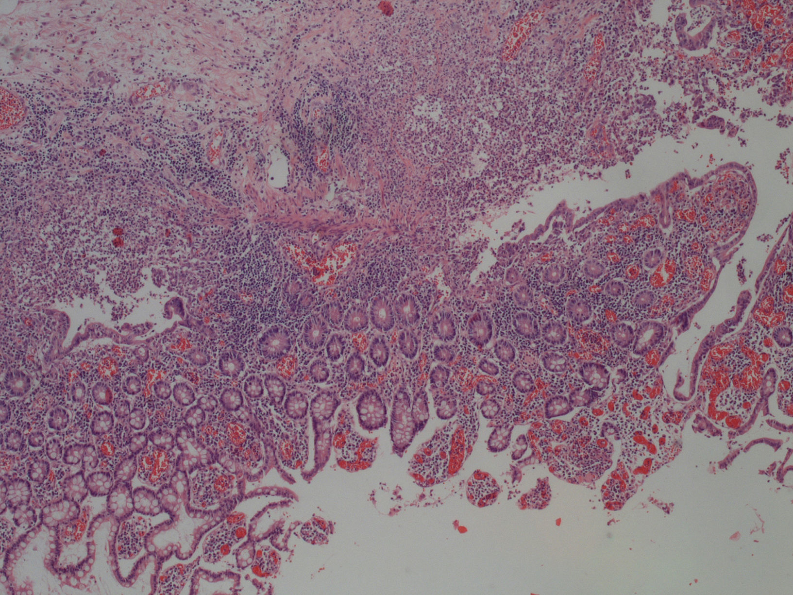 Ileítis tras colectomía por colitis ulcerosa | Cirugía Española