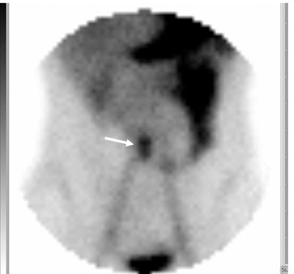Hemorragia digestiva secundaria a úlcera en conducto onfalomesentérico ...