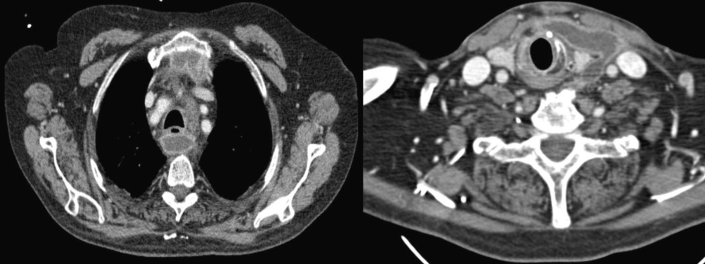 Divertículo faringoesofáfico perforado como causa de infección cervical ...