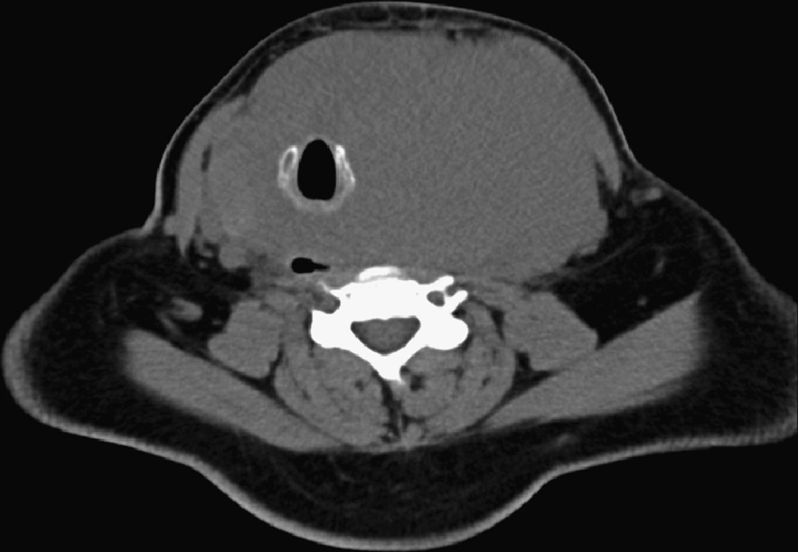 Signo del donut en el linfoma tiroideo | Cirugía Española