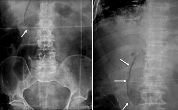 Colecistitis aguda enfisematosa | Cirugía Española Colecistitis aguda enfisematosa | Cirugía Española