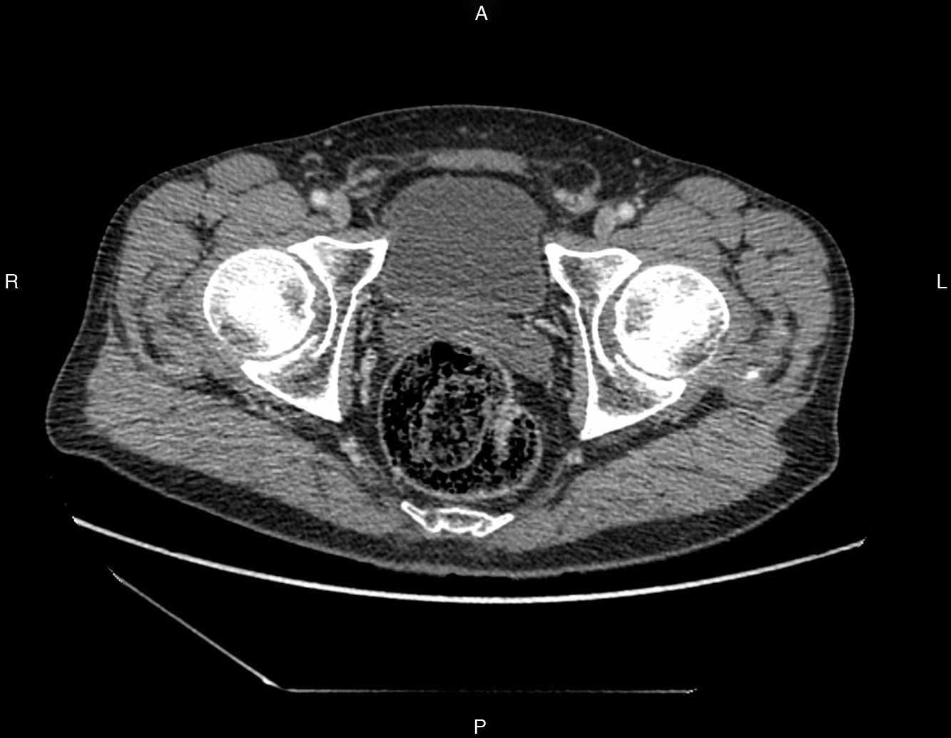 Oclusión intestinal por fitobezoar recidivante: resolución con ...