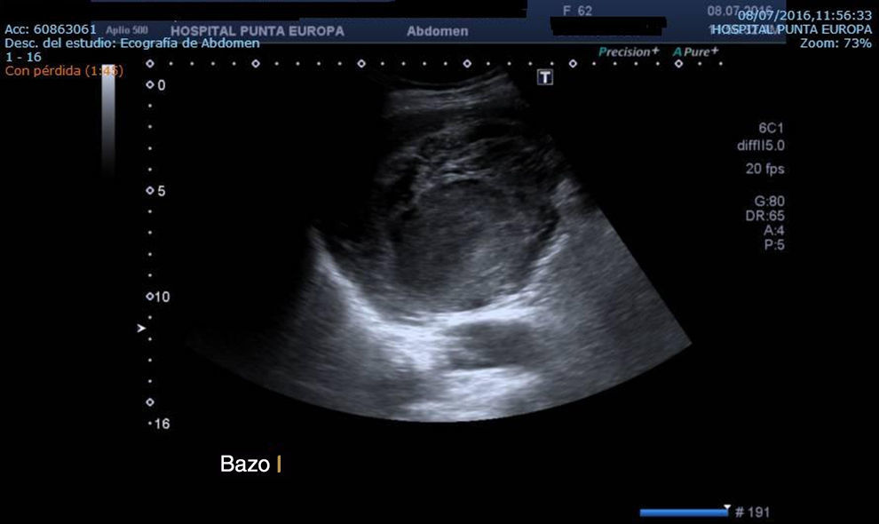 Hemoperitoneo masivo secundario a rotura esplénica tras litotricia ...