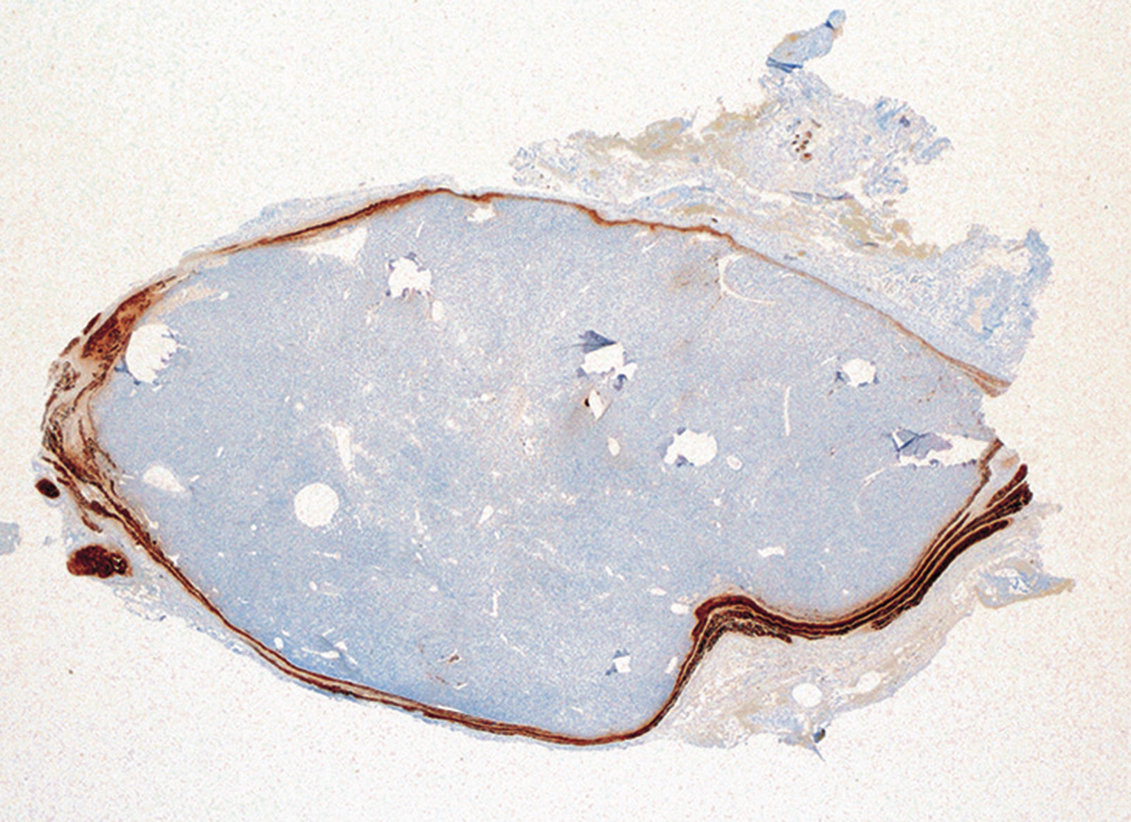 Adenoma paratiroideo intravagal con cirugía de abordaje directo ...