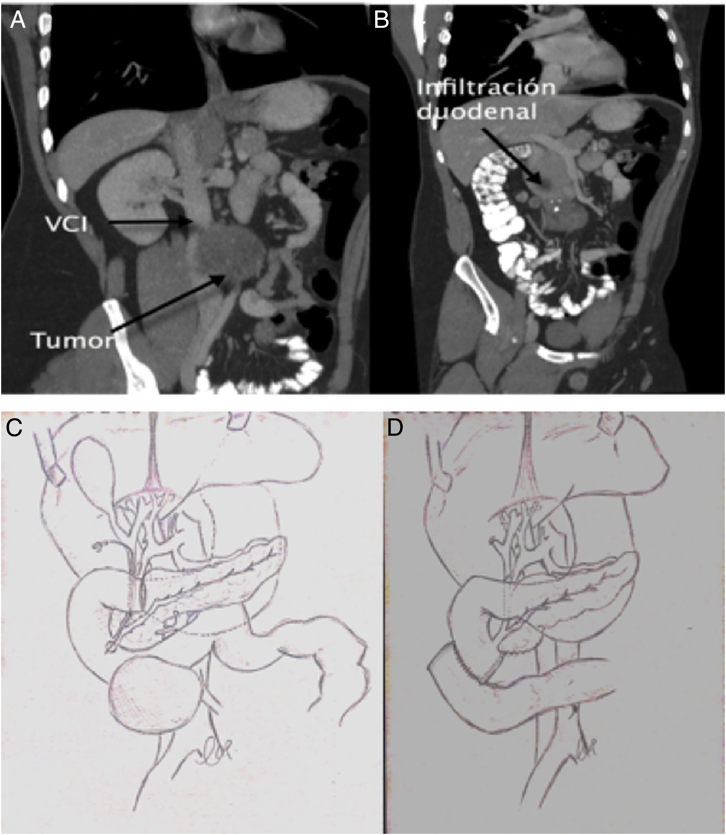 Pancreas sparing duodenectomy como tratamiento de tumor germinal con ...