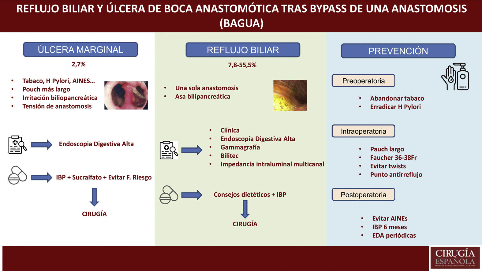 Reflujo biliar y úlcera de boca anastomótica tras bypass de una ...
