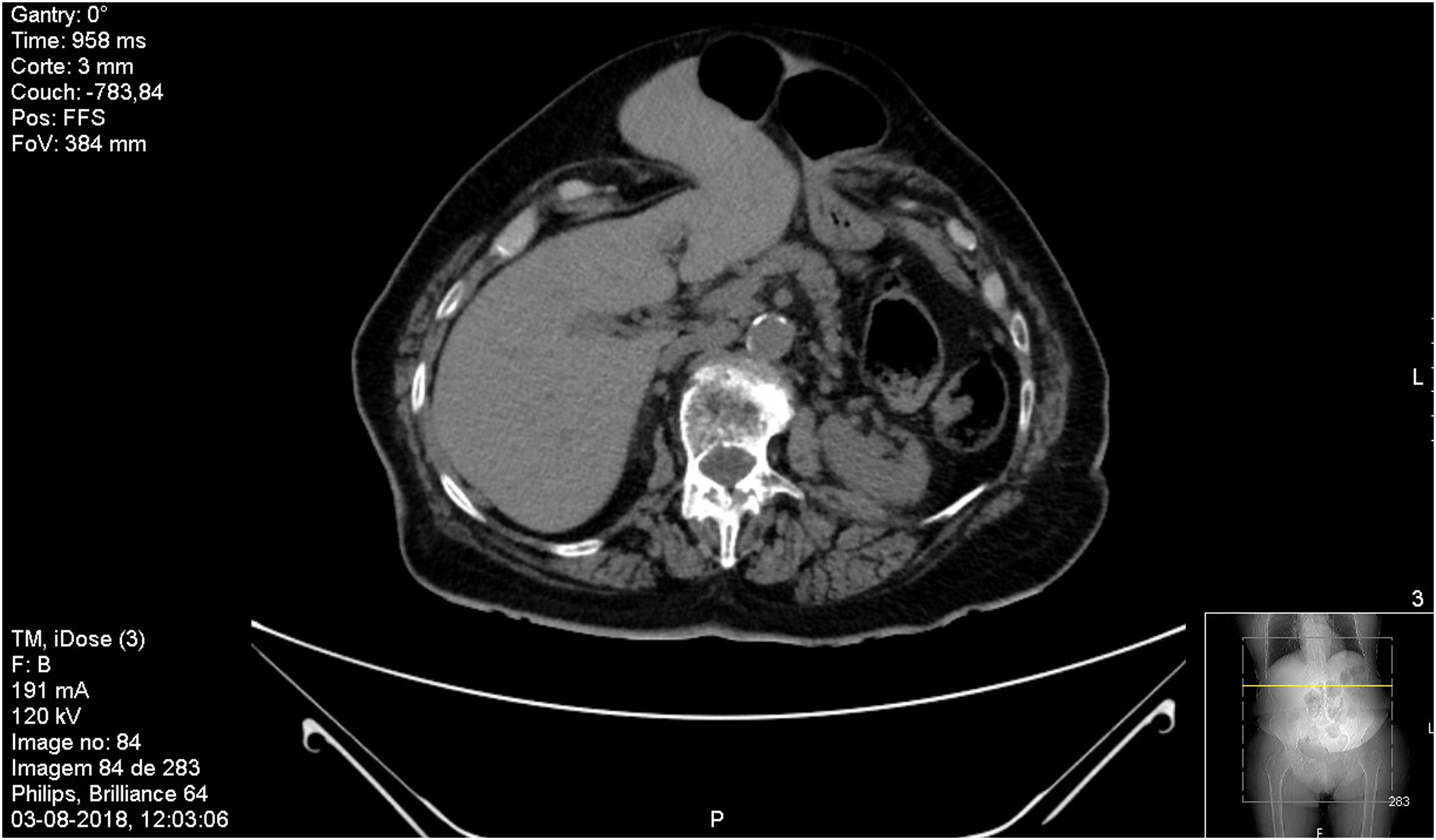 Hepatic herniation: A rare presentation of abdominal incisional hernia ...
