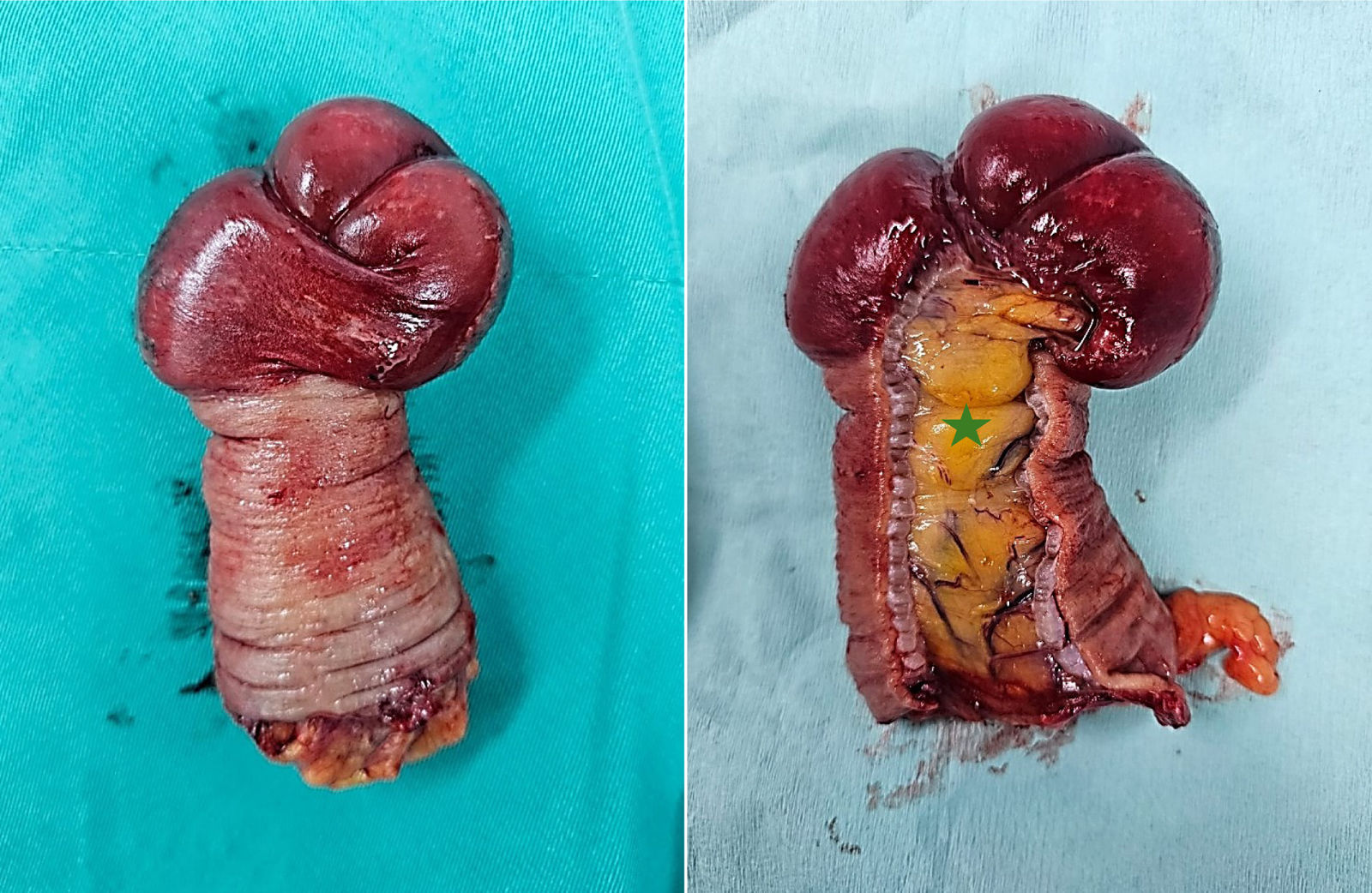Prolapso epiploico de asa eferente de colostomía | Cirugía Española