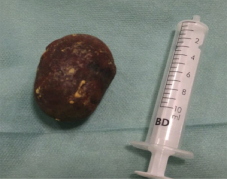 Íleo biliar colónico: una rara causa de obstrucción intestinal ...