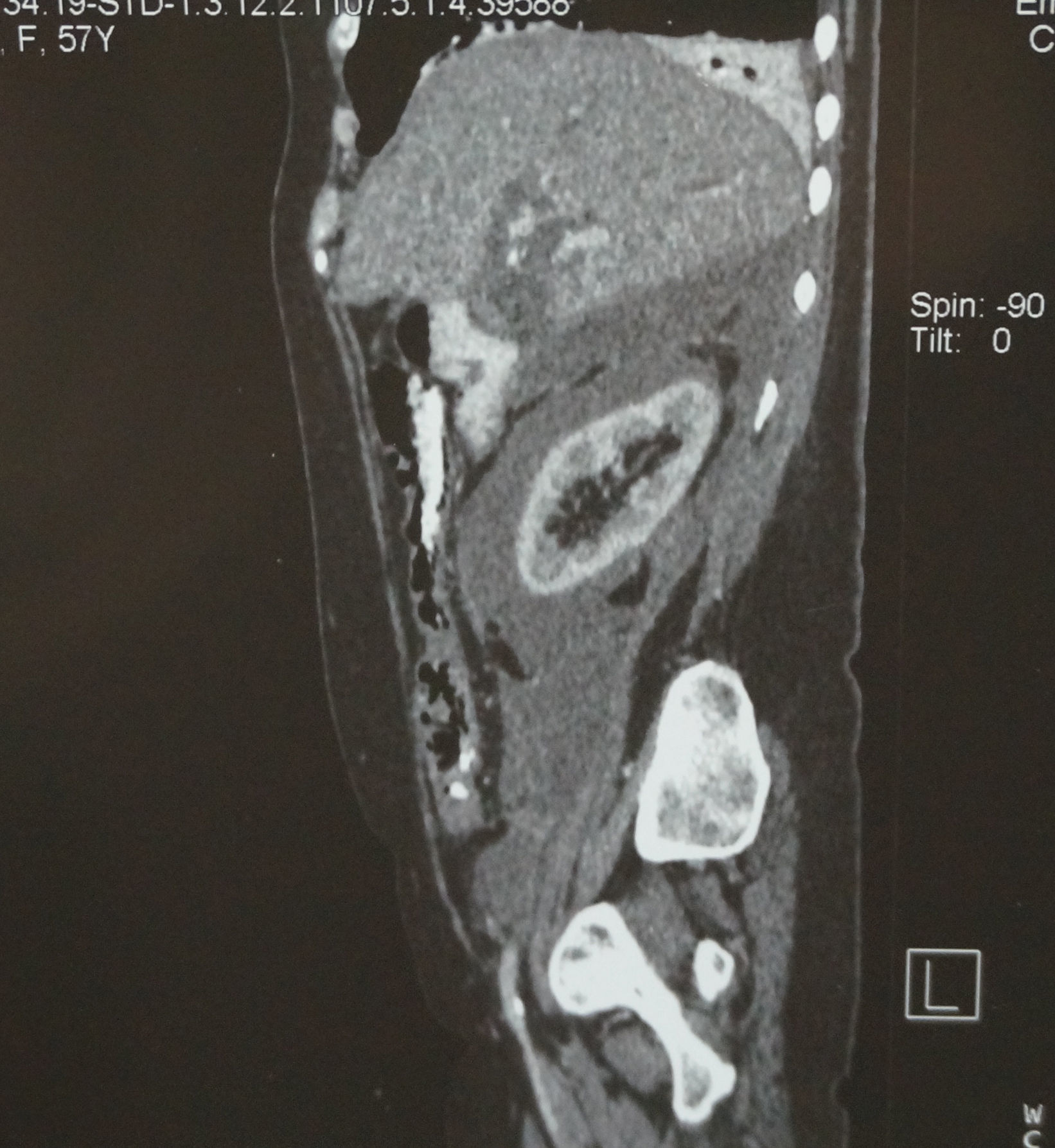 Biloma retroperitoneal espontáneo: reporte de un caso | Cirugía y Cirujanos