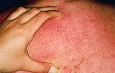 Extensa induración cutánea en región dorsal | Revista Clínica Española