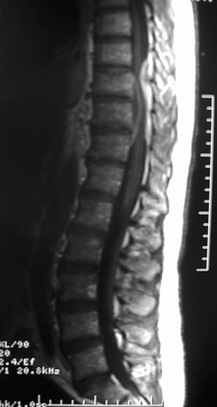 Absceso epidural espinal sin espondilodiscitis.Descripción de cuatro ...