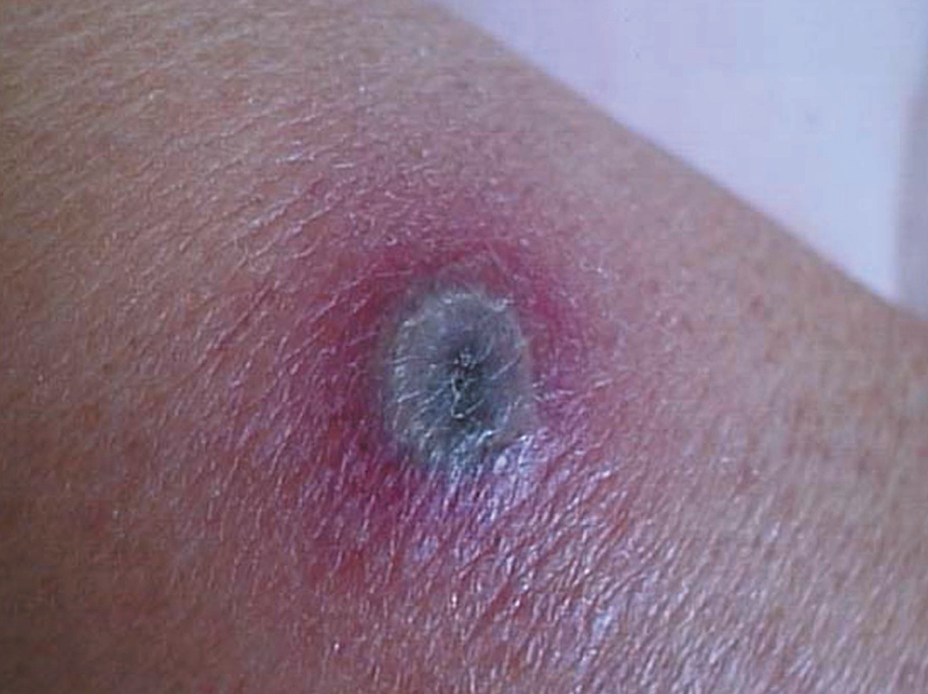 Fiebre y lesión necrótica cutánea | Revista Clínica Española