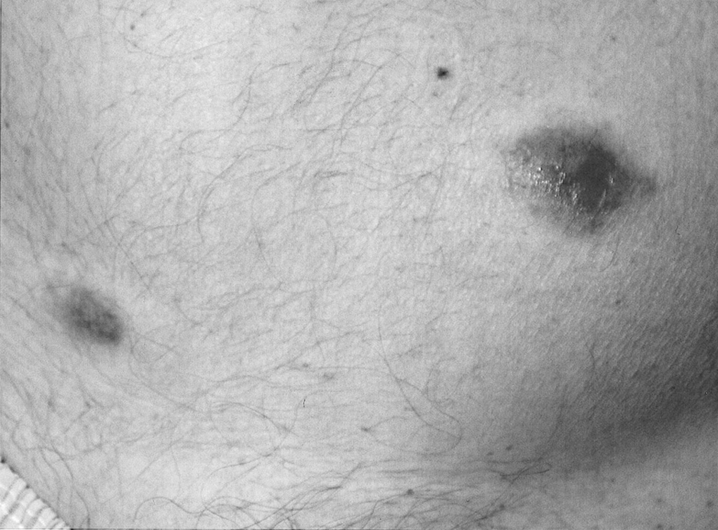 Lesiones cutáneas nodulares