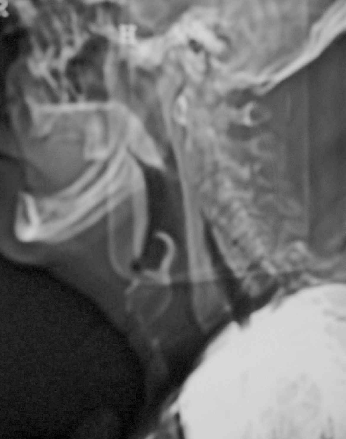 Fístula esófagica-extradural secundaria a tuberculosis vertebral ...