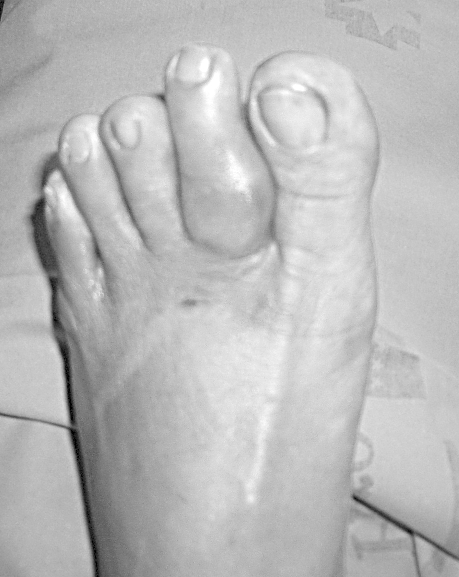 Mujer de origen filipino con tumoración en un pie | Revista Clínica ...
